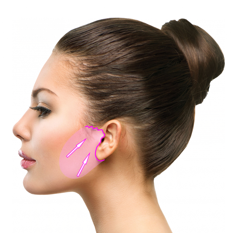 Facelifting Berlin - Allgemeine Information - Kirsten-derma